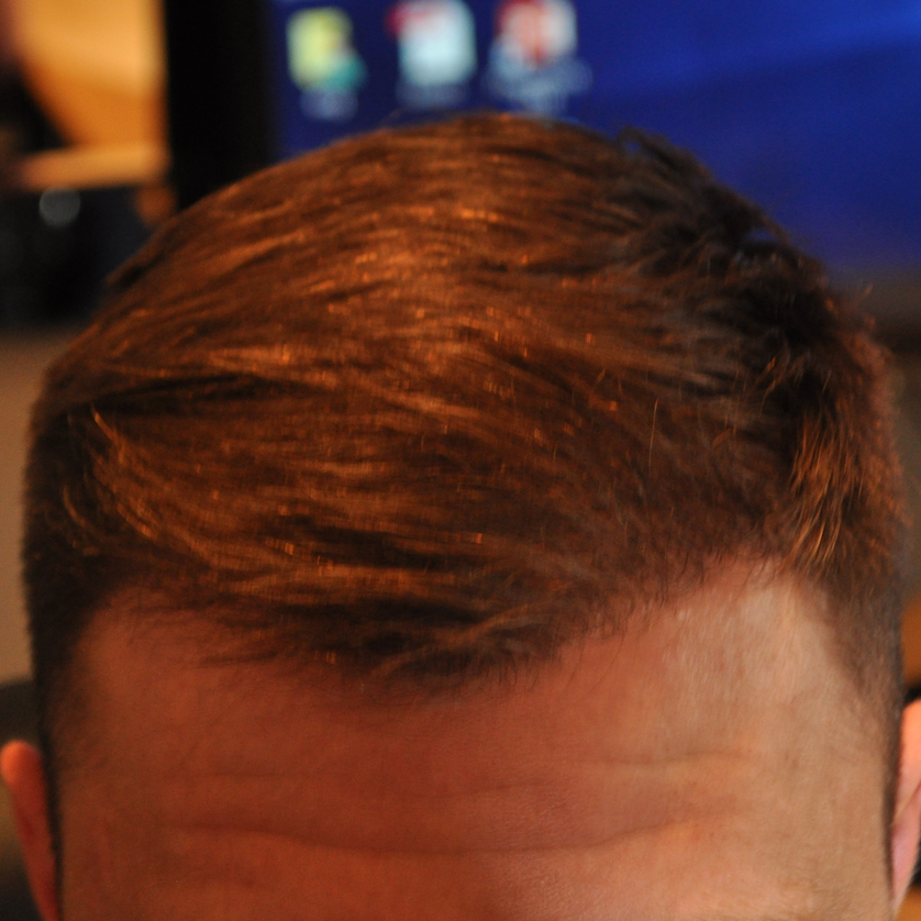 FUE Vs FUT: What’s The Difference? | Wimpole Clinic