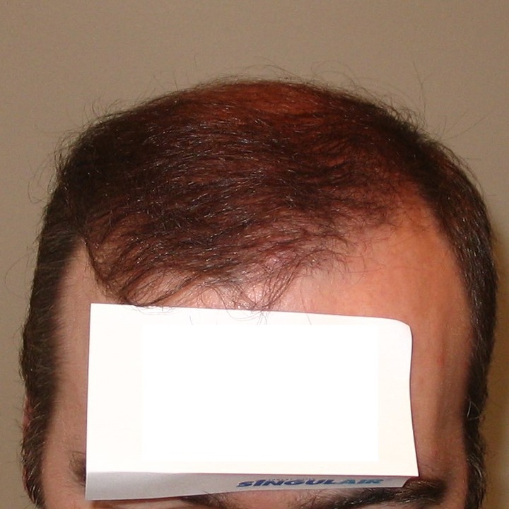 Norwood Stage 5: Photos, Treatments, Results | Wimpole Clinic