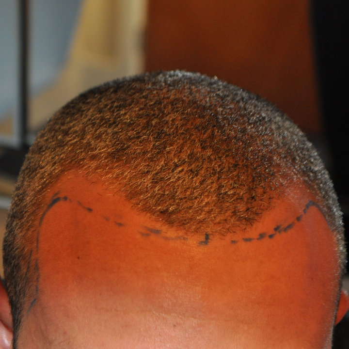 Frontal Balding: Causes, Symptoms, Treatments | Wimpole Clinic