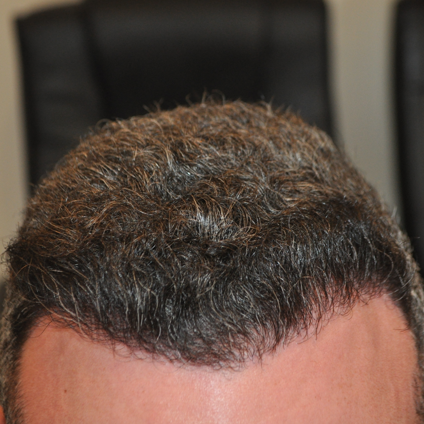 How Many Hair Grafts Do I Need? | Wimpole Clinic