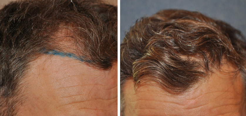 My Dad Is Bald, Will I Go Bald? Baldness Gene Explained - Wimpole Clinic