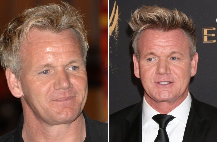 Gordon Ramsay Hair Transplant: Everything You Need To Know
