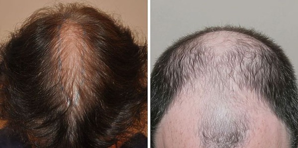 10 Reasons Your Hair Feels Thinner and How to Treat It