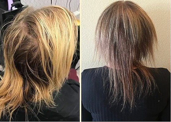 Hair Thinning In Women: Common Causes & Treatment Options