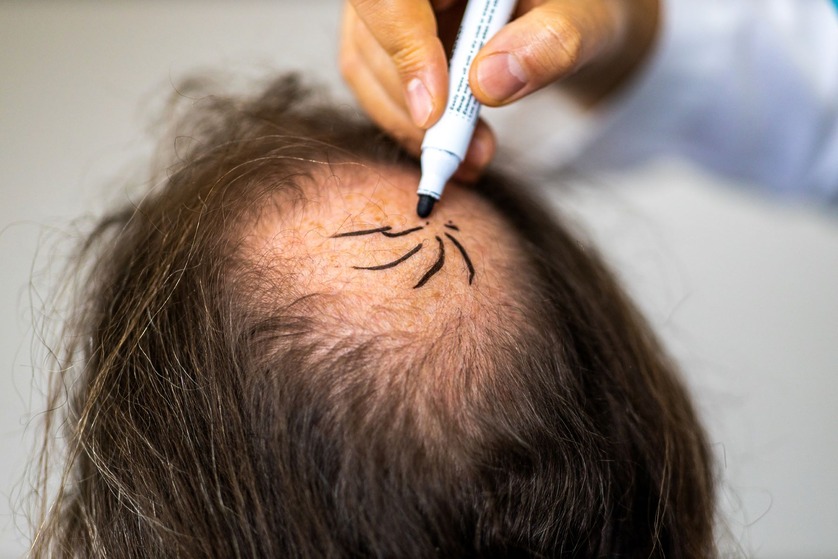 Can A Bad Hair Transplant Be Fixed? | Wimpole Clinic