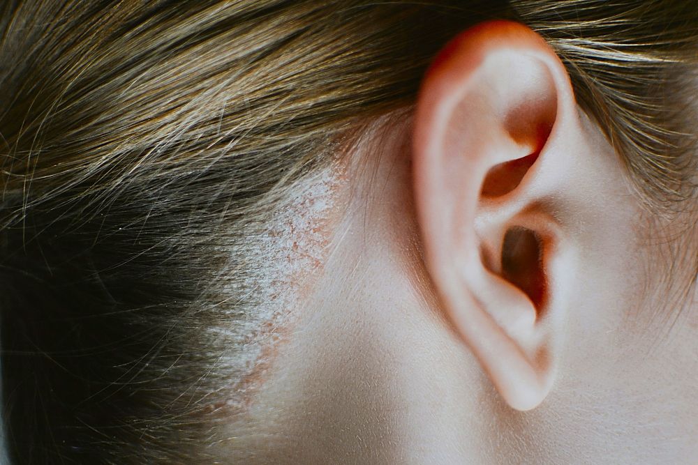 Psoriasis Scalp