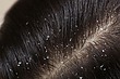 12 Reasons Your Scalp Itches a Day After Washing and What to Do