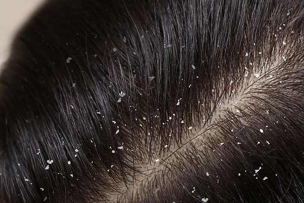 8 Common Scalp Problems: Photos, Causes, Treatments