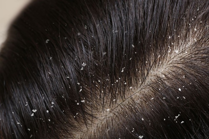 23 Causes Of An Itchy Scalp, According To The NHS