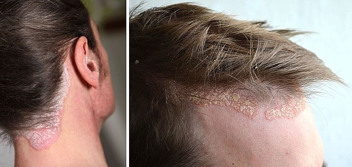 8 Common Scalp Problems: Photos, Causes, Treatments