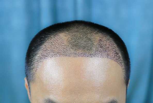 Uneven Hairlines: Causes, Symptoms & How To Fix It