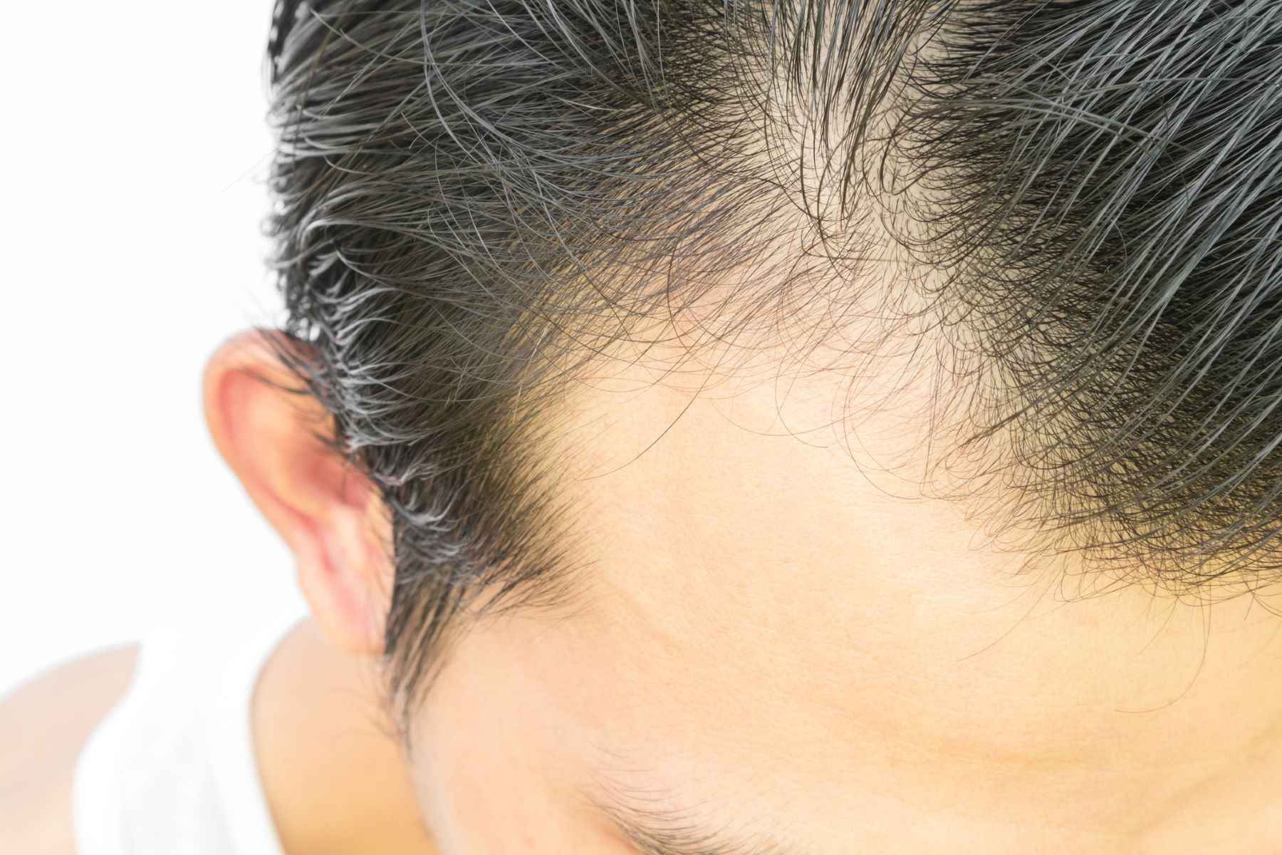 Finasteride Shedding: What Is It And Why Does It Happen?