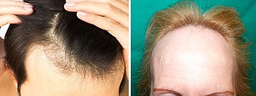 Mature Hairline Vs Receding Hairline: Which One Is Yours?