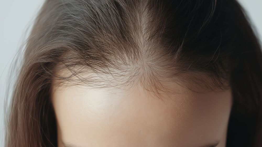 Female Pattern Baldness: Causes, Stages & Treatment Options