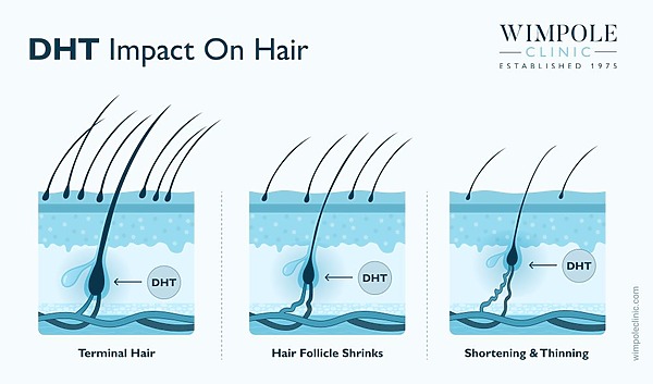Thyroid Hair Loss: How To Spot Its Signs and Reverse It