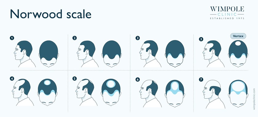 7 Ways To Tell Your Hairline Is Receding And The Best Treatments