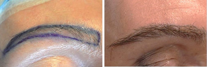 How To Grow Back Overplucked Eyebrows | Wimpole Clinic