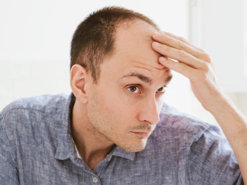 Norwood Scale: Causes, Stages & Treatments | Wimpole Clinic