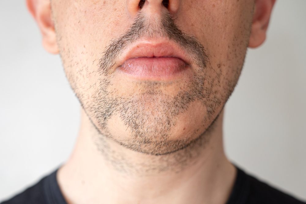 Alopecia Barbae: Causes, Diagnosis & Treatment | Wimpole Clinic