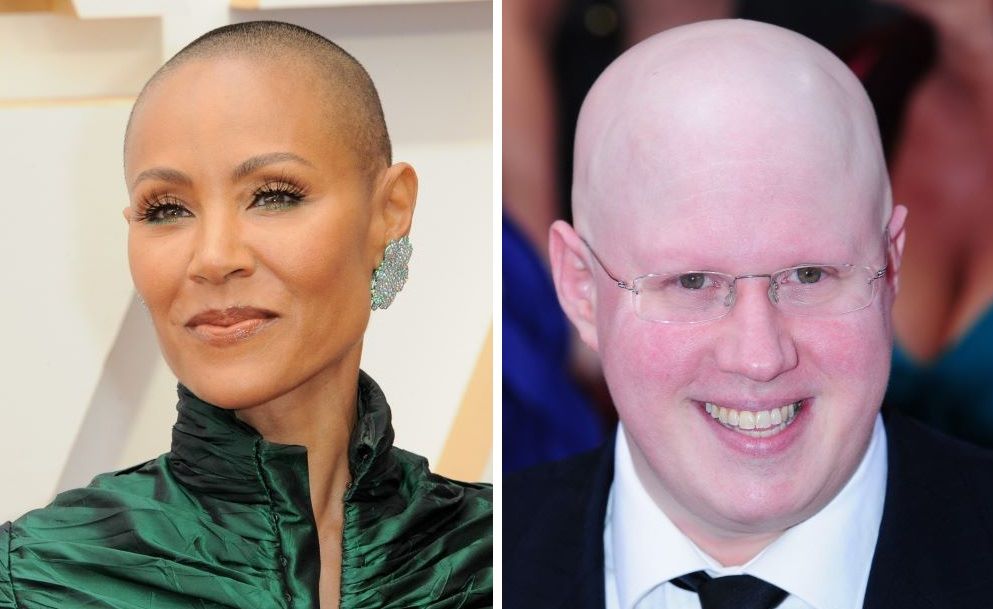 12 Celebrities With Alopecia And Hair Loss Wimpole Clinic