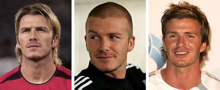 David Beckham Hair Transplant: Everything You Need To Know