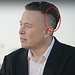 Elon Musk’s Hair Transplant: Full Timeline, Cost and Results