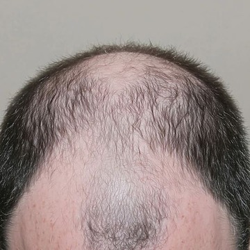 Does Low Testosterone Cause Hair Loss?