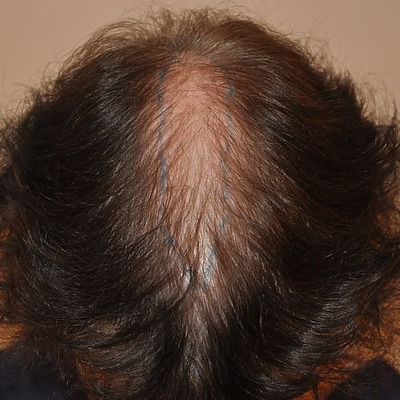 Female Pattern Baldness: Causes, Stages & Treatment Options