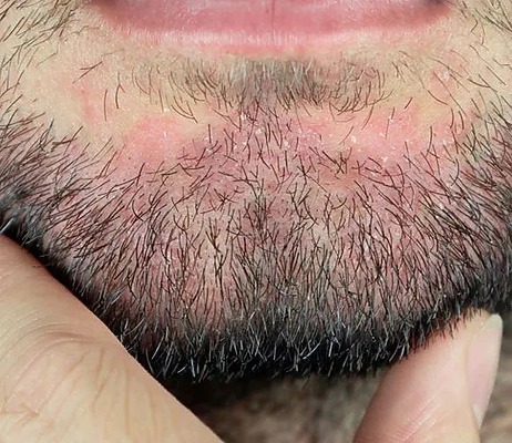 Fixing Beard Bald Spots From Alopecia Barbae & Other Causes