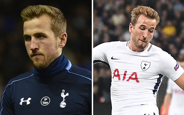 Harry Kane Hair Transplant: Everything You Need To Know