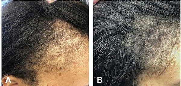 Minoxidil For A Receding Hairline: Benefits, Risks, Results