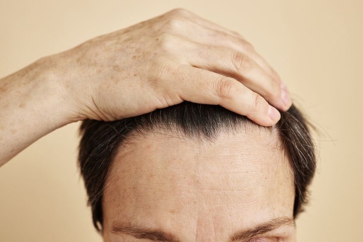 Frontal Balding: Causes, Symptoms, Treatments | Wimpole Clinic