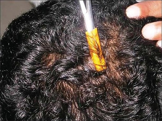 Blood Tests for Hair Loss: Diagnosing Female Hair Thinning