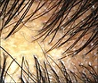 Blood Tests for Hair Loss: Diagnosing Female Hair Thinning