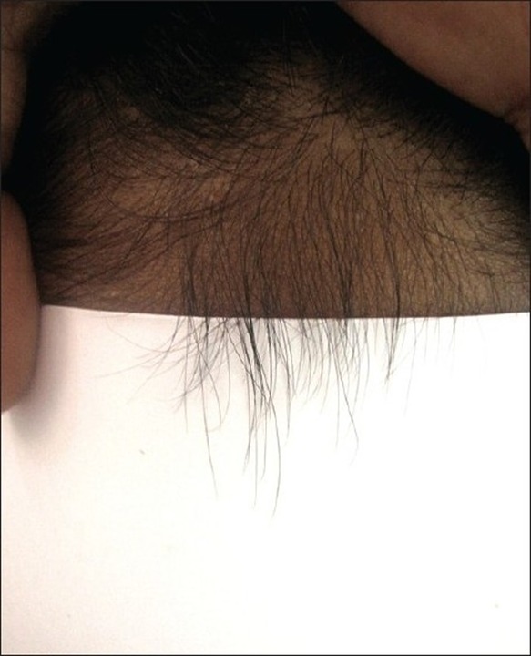 Blood Tests for Hair Loss: Diagnosing Female Hair Thinning