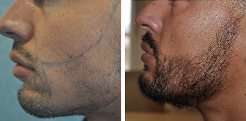 FUE Hair Transplants: Procedure, Results, Recovery and Costs