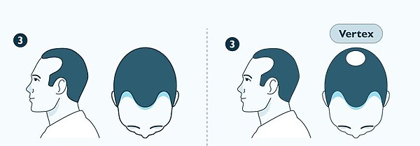 Norwood Stage 3: Photos, Treatments, Results | Wimpole Clinic