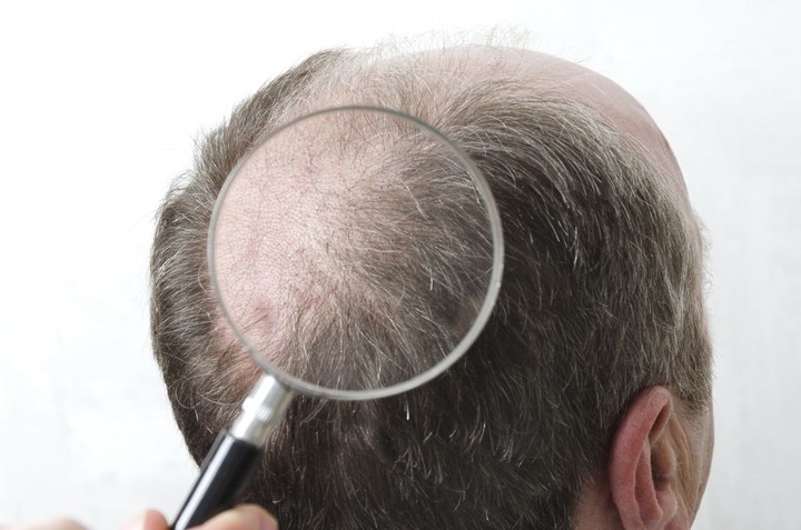 Double Crown Vs Balding: Differences, Symptoms, Treatments