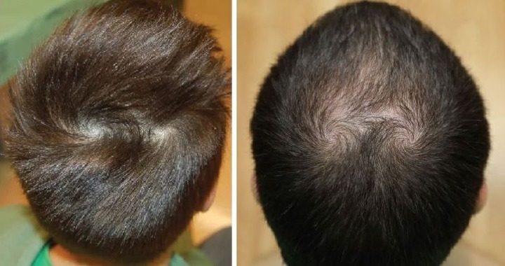 Double Crown Vs Balding: Differences, Symptoms, Treatments