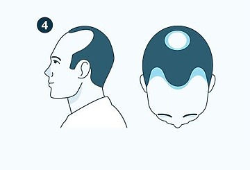 Norwood Stage 4: Photos, Treatments, Results | Wimpole Clinic