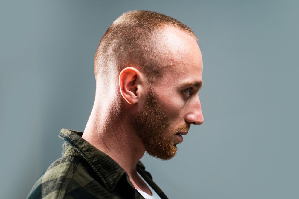 Norwood Stage 4: Photos, Treatments, Results | Wimpole Clinic