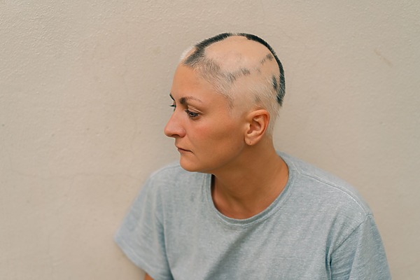 The Baldness Cure: How Close Is It And Is It Worth the Wait?