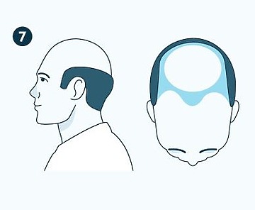 8000 Grafts Hair Transplant: Coverage, Results, Costs