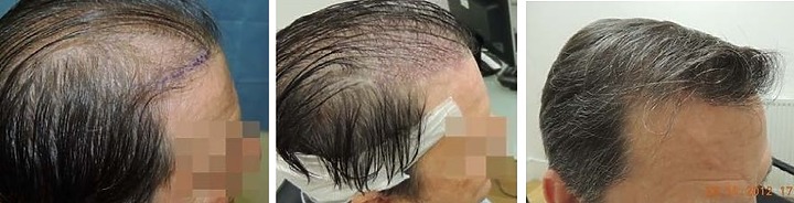 Can You Get A Hair Transplant Without Shaving Your Head?