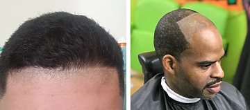 How to Fix Your Hairline: 9 Ways to Get It Back on Track