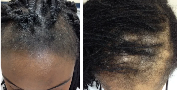 How To Fix A Messed Up Hairline - Wimpole Clinic