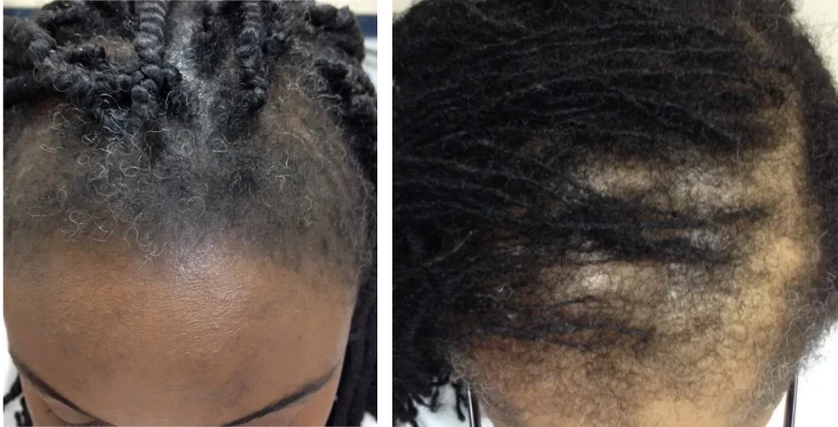 How To Fix A Messed Up Hairline - Wimpole Clinic