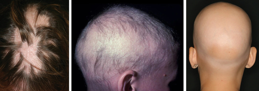Alopecia Totalis: Causes. Symptoms, & Treatment - Wimpole Clinic