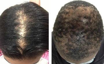 Types Of Alopecia: Causes, Symptoms, Treatments - Wimpole Clinic