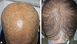Types Of Alopecia: Causes, Symptoms, Treatments - Wimpole Clinic